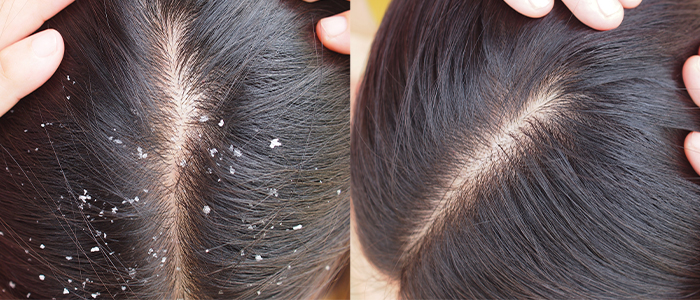 Dandruff, what is it? How do we get rid of it?